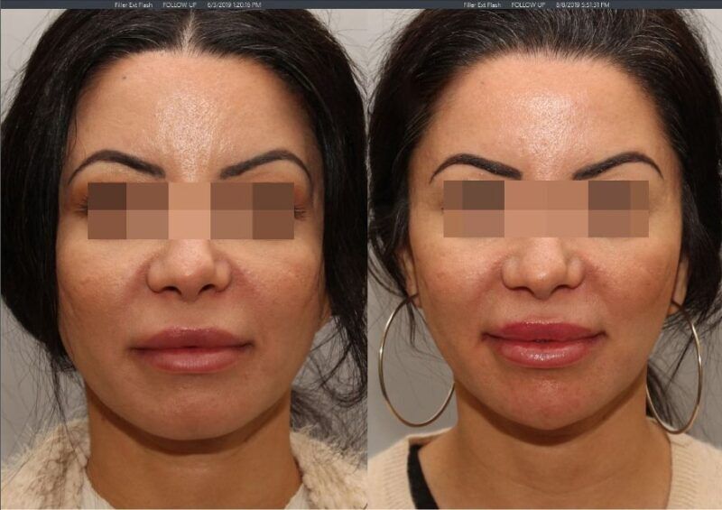 Book A Masseter BOTOX Treatment In Torrance | Lumier Medical