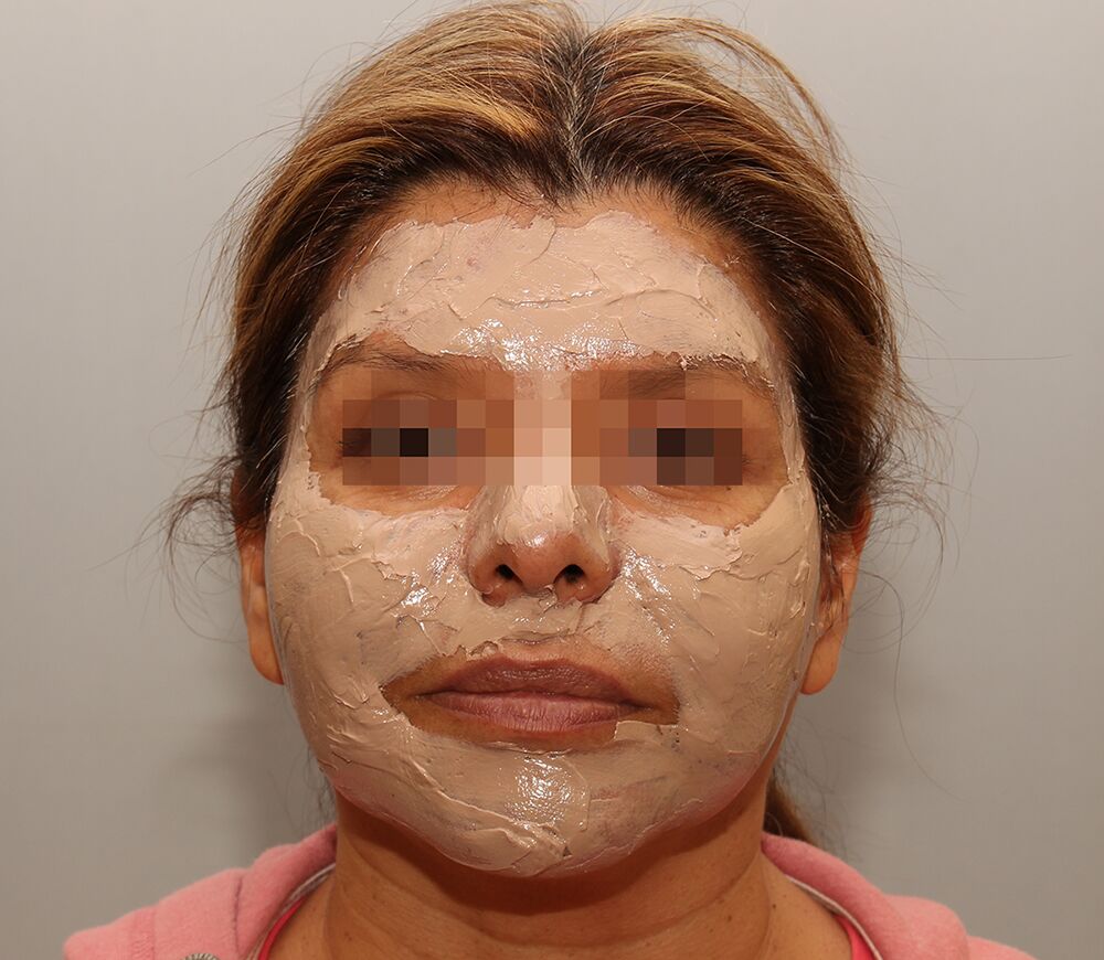 Melasma Treatment Torrance | Cosmelan MD Treatment