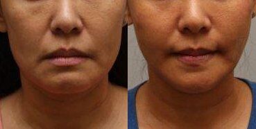 Masseters Botox Before & After Photos | Lumier Medical Torrance